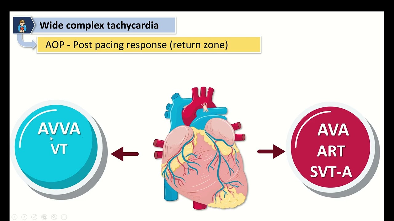 Atrial overdrive pacing (AOP)