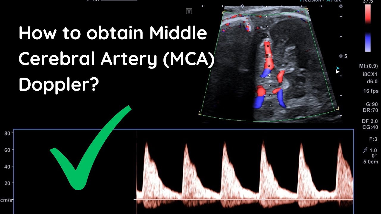 Ultrasound Doppler Middle Cerebral Artery (MCA), How to obtain MCA? How to interpret?