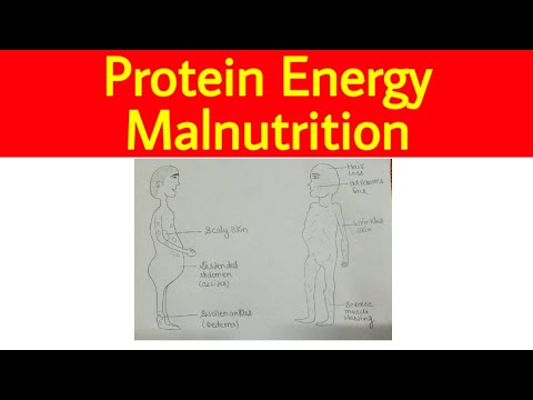 Protein energy malnutrition II PEM