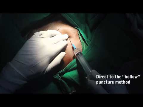 Direct Puncture of Axillary Vein (Modified Low Approach)