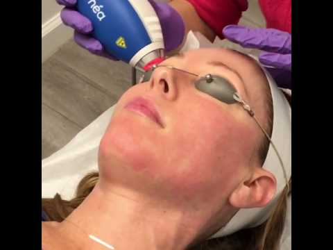 Schweiger Dermatology Group's Dr Wee performs laser treatment
