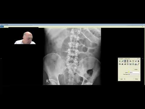 Severe left iliac fossa pain, with weight loss, fever. What is the likely diagnosis ?