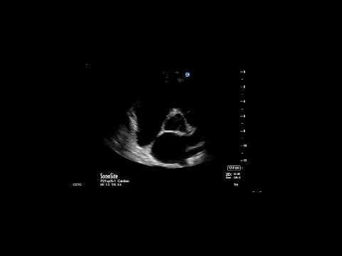 How to...Measure Mean Pulmonary Artery Pressure From Tricuspid Regurgitation