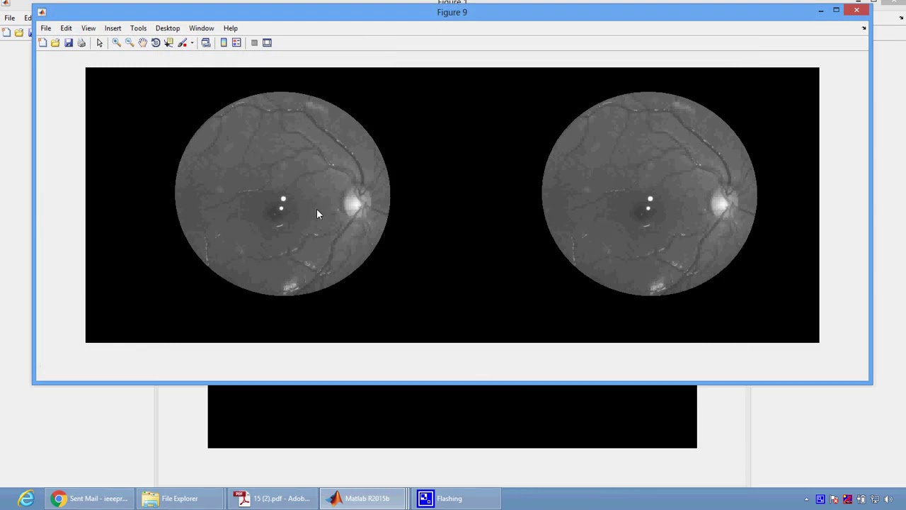 Detecting Diabetic Retinopathy Using Deep Learning In Matlab Okok Projects Final Year