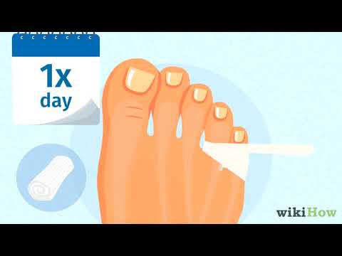 How to Tape a Broken Pinky Toe