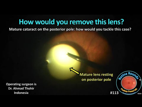 RetinaRounds™ 113: How would you remove this lens?