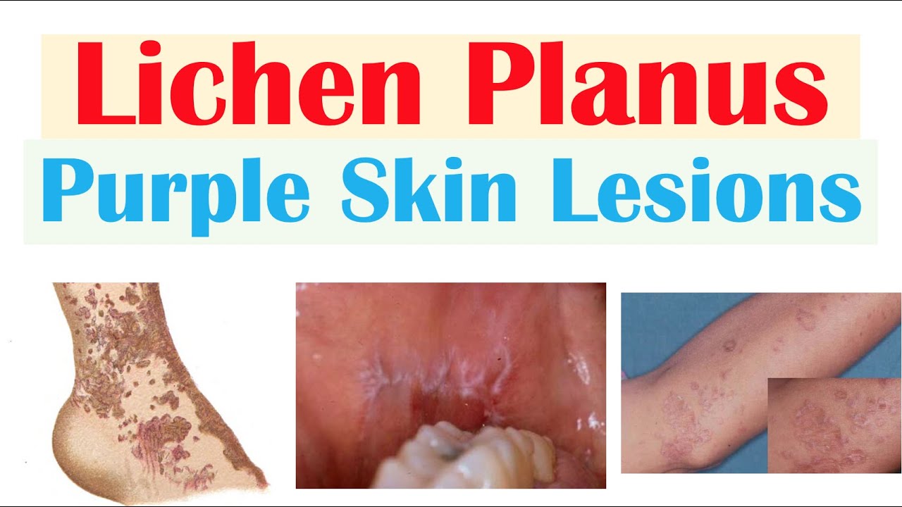 Lichen Planus (“Purple Skin Lesions”) | Causes, Signs & Symptoms, Diagnosis, Treatment