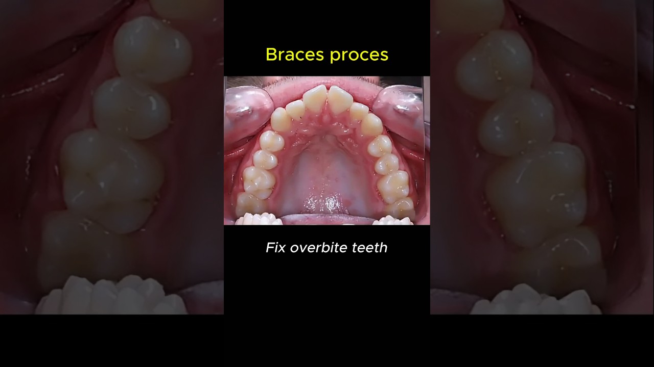 How to fix overbite teeth? Braces process transform #dentist #braces #orthodontist