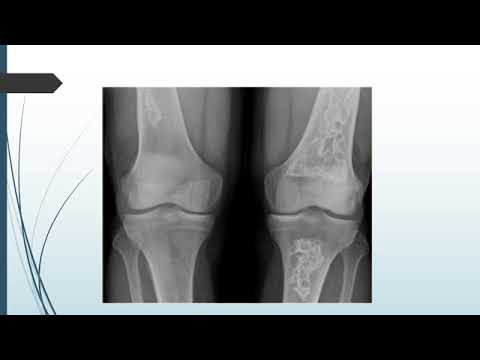 cottage loaf sign, bone infarction