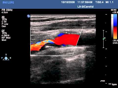 ICA DISEASE COLOR DOPPLER