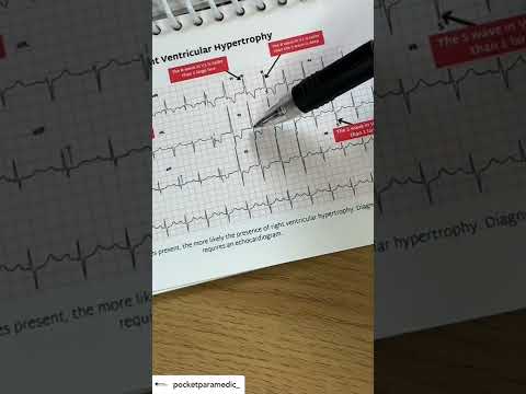 ST depression - right ventricular hypertrophy vs cardiac ischaemia