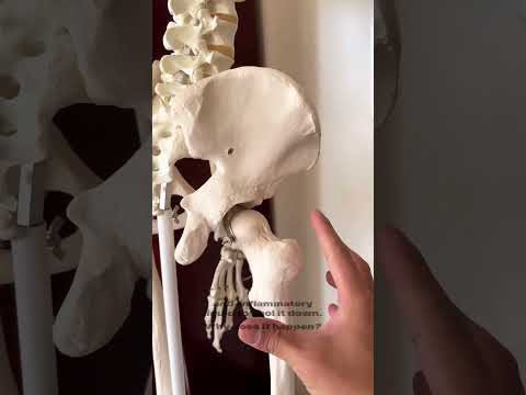 Is it Hip Bursitis? Let's Find Out Together