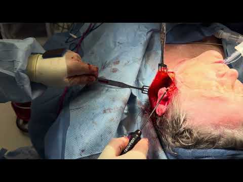 Lets Talk RENUVION! Skin Tightening Face/Neck With Dr.Alan Durkin (4K) #renuvion #plasticsurgery