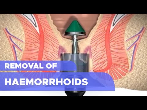 Removal of Haemorrhoids