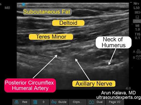 Ultrasound Guided Axillary Nerve Block