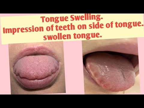 Tongue Swelling.Scalloped Tongue, Tongue pain. impression of teeth on side of tongue.swollen tongue.