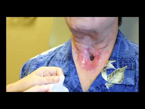Application of Provox StabiliBase
