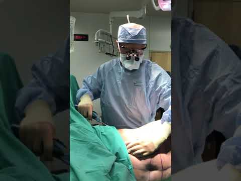 Liposuction of the lateral abdomen