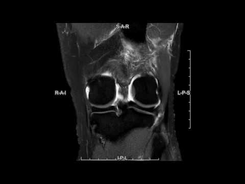 Chondral injury of the knee - complete MRI examination