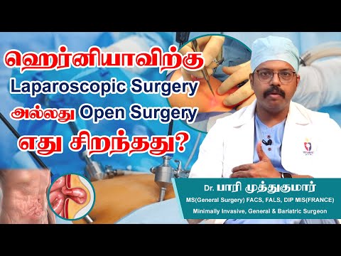 Surgery for Hernia | Laparoscopic Surgery or Open Surgery | ஹெர்னியாவிற்கு எது சிறந்தது? குடலிறக்கம்