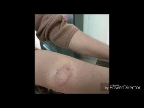 Approach to hypopigmented patch in WC