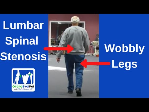 Lumbar Spinal Stenosis Symptoms (Neurogenic Claudicatiion)