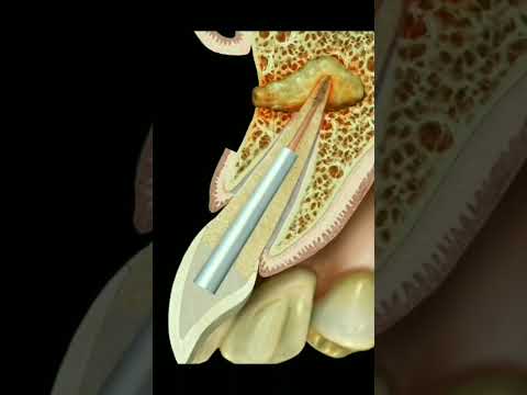 What after root canal treatment fails? - Apicoectomy #shorts #dentistry #short #shortvideo #status
