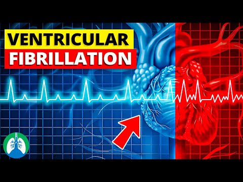 Ventricular Fibrillation (V-fib) | Medical Explainer Video