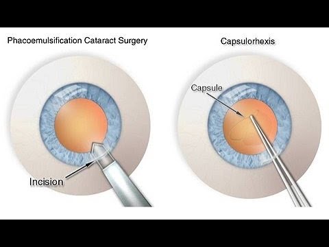 Extracapsular Cataract Surgery CPT codes - simplify medical coding