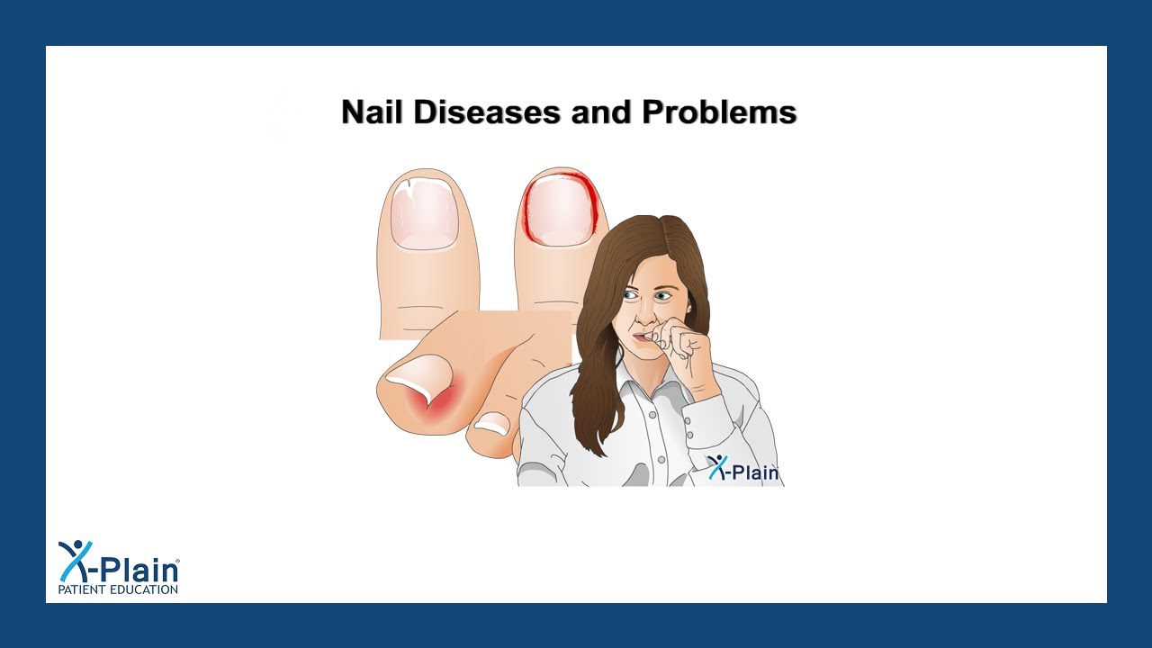Nail Diseases and Problems