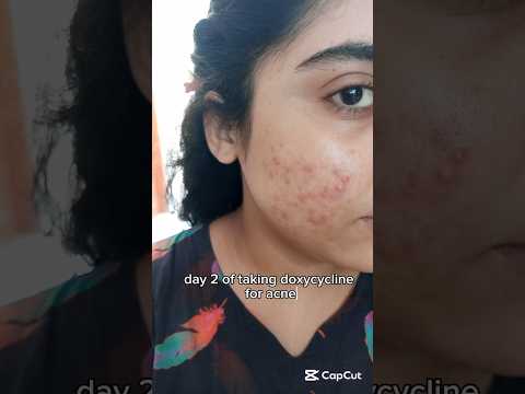 day 2 of taking doxycycline for acne π sharing my acne journey π oral antibiotics for severe acne