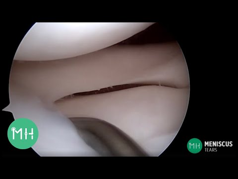 What is a meniscus?