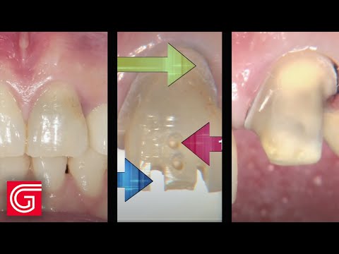HOW TO Prepare Anterior Teeth Using a Reverse Preparation Technique