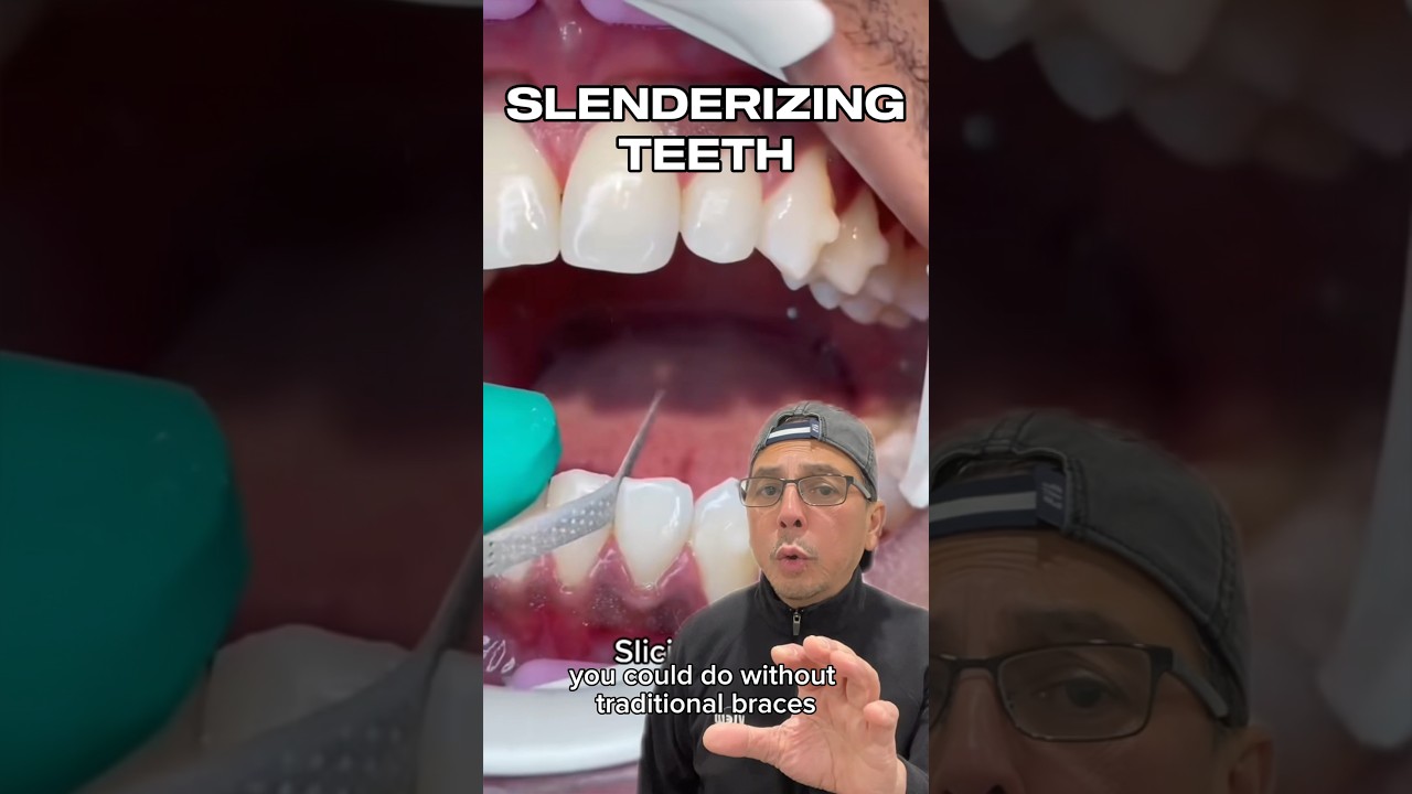 How Invisalign Can Fix Minimal Crowding of Teeth | View Mobile Dental #shorts