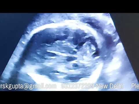 Blake Pouch cyst and Arachnoid Cyst on ultrasound in same fetus