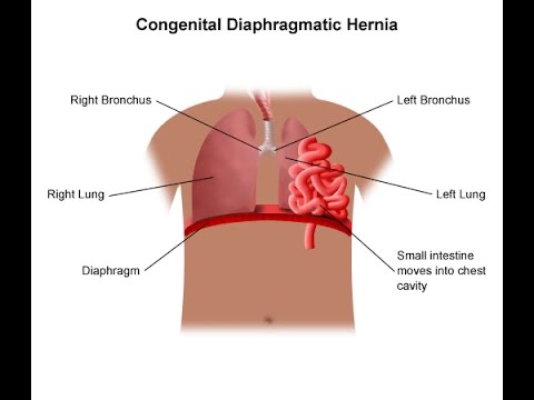 Diaphragmatic Hernia