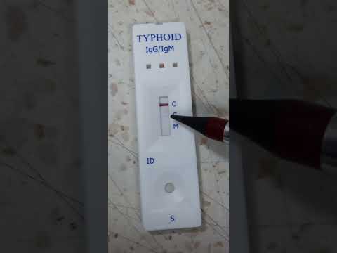 Typhoid IgG/IgM Rapid Test shows Positive IgG.