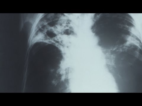 World TB Day - Transmission of TB (part 2 of 6)