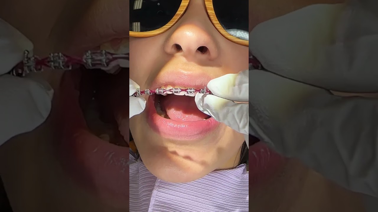 Removing Braces
