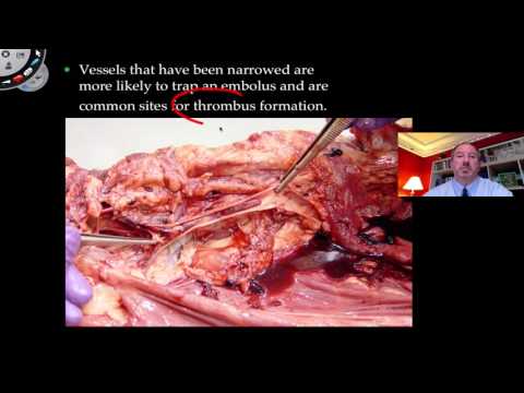 Cardiovascular Diseases