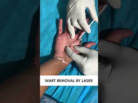 Warts Removal With Laser Treatment | Safe and Effective Wart Removal Treatment | Skinaa Clinic#viral