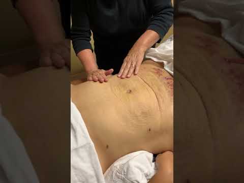 Post Lipo MLD/Manual Lymphatic Drainage