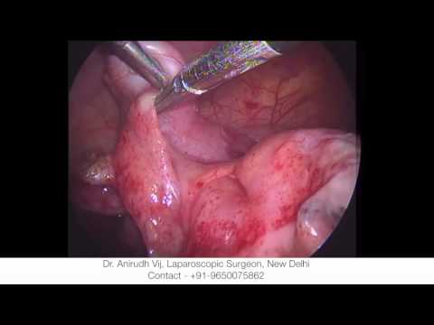 laparoscopic appendicectomy for perforated appendix