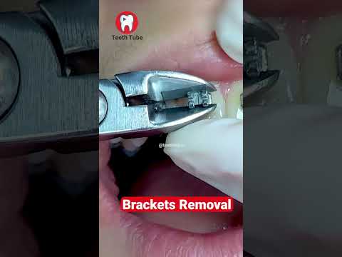 Brackets Removal #shorts