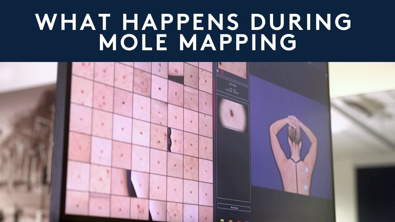 What happens during mole mapping? Here's why you should check your moles