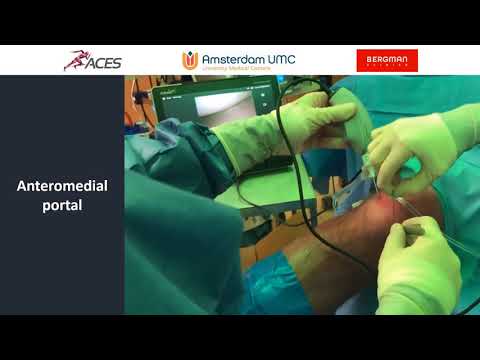 Needle Arthroscopic All Inside Repair of Meniscal Tears Under Local Anesthesia