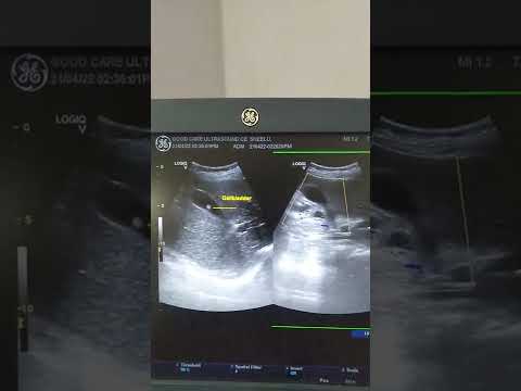 Gallbladder sludge ball🏀. ultrasound