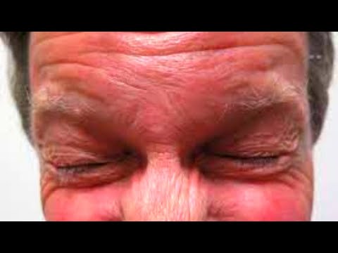 What is Blepharospasm? Symptoms, Causes, Treatment