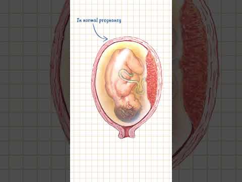 Understanding Oligohydramnios And Low Amniotic Fluid