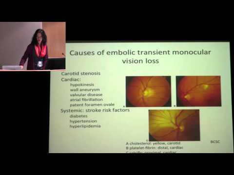 Transient Vision Loss due to Embolism or Vasculitis